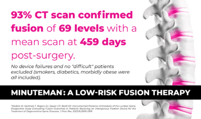 The Minuteman Procedure - The IVP Group