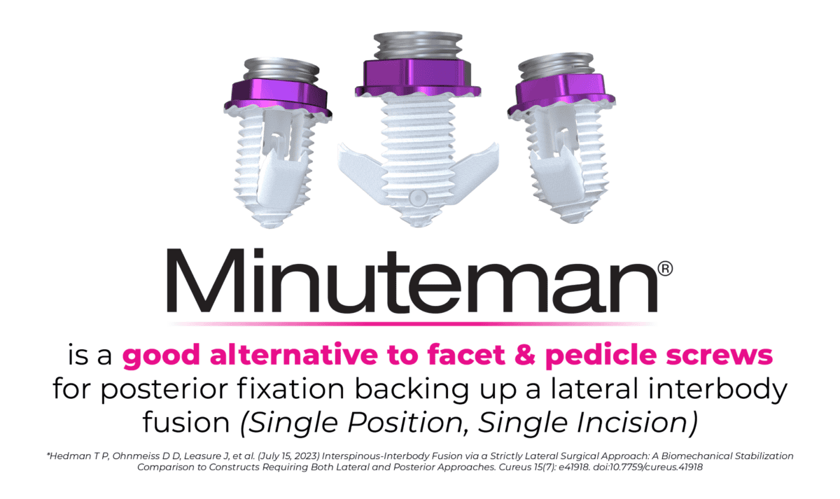 The Minuteman Procedure - The IVP Group